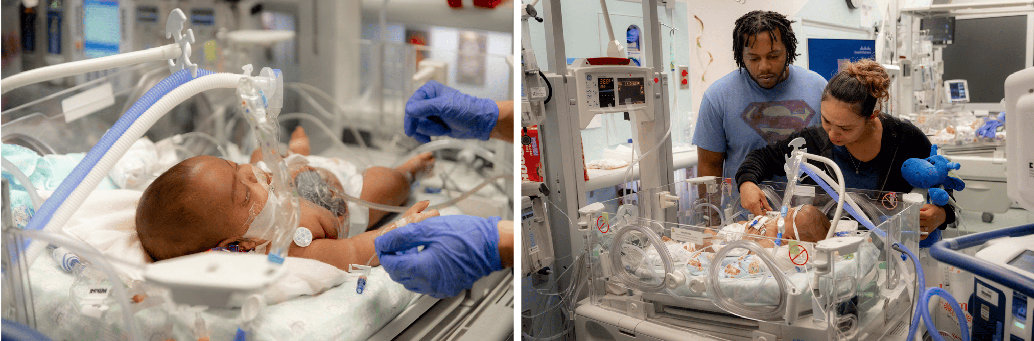 Conjoined at Birth: When One Becomes Two