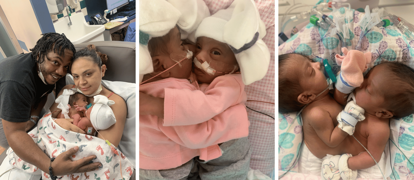 Conjoined at Birth: When One Becomes Two